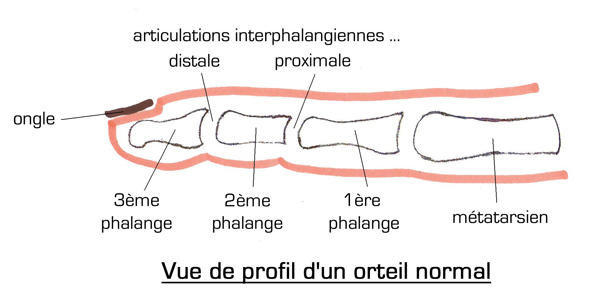 Griffes d’Orteil et cors – Avant-Pied.fr