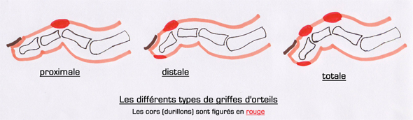 Griffes d’Orteil et cors – Avant-Pied.fr